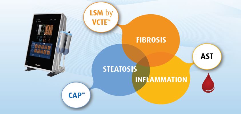 FAST: An Advancement in the Identification of Fibrotic NASH